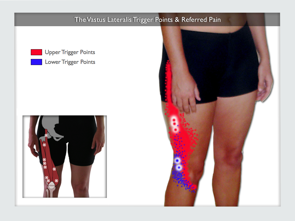 Vastus Lateralis Trigger Points The Knee Pain Trigger Points Part 1 Vastus Lateralis Trigger Points The Knee Pain Trigger Points Part 1